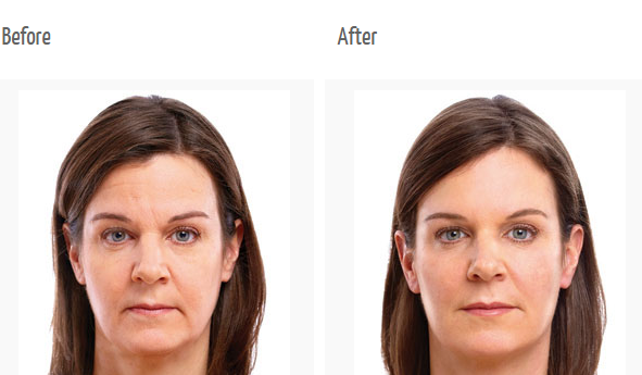 Soft Lift™ | Skin Vitality Medical Clinic